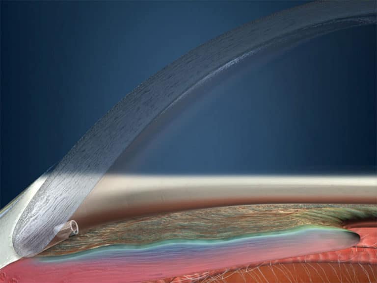 Hattiesburg Eye Clinic | iStent® Implants